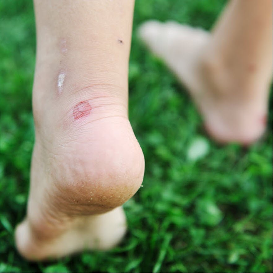 Open Blisters Running Blisters Treatment And Prevention