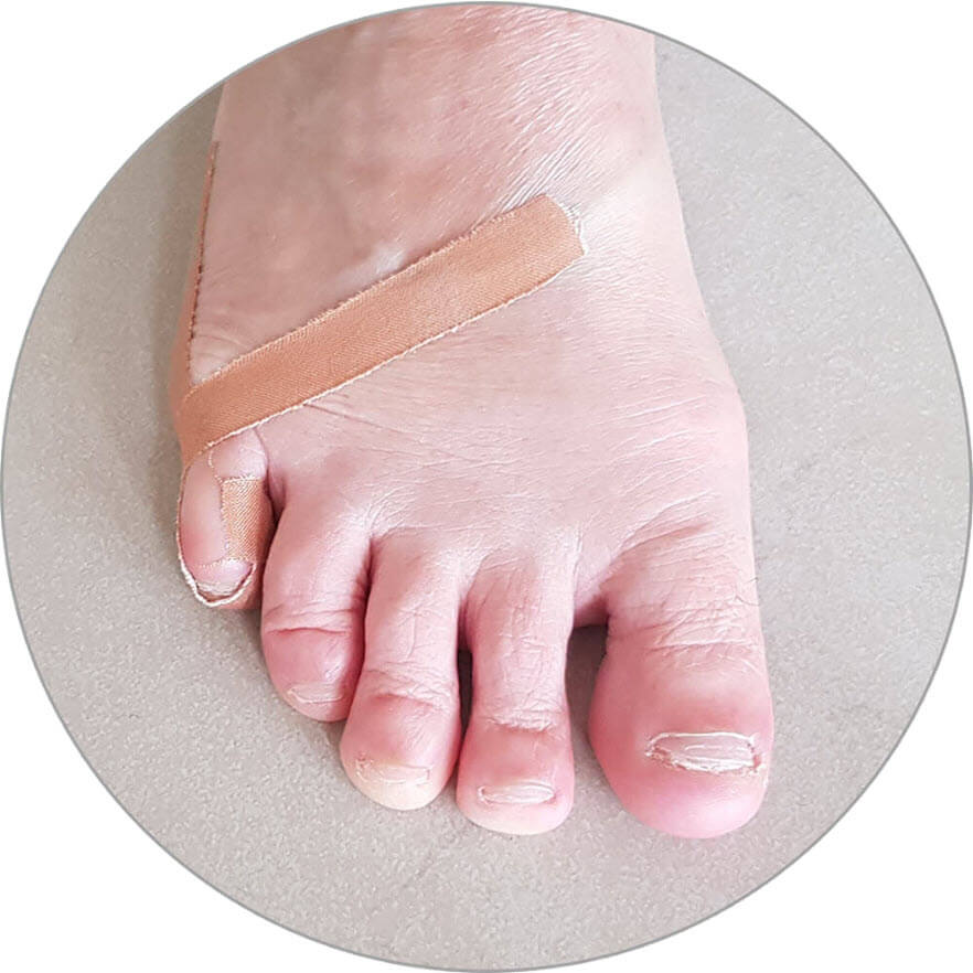 How To Hold A Curly Toe Straight With Strapping Tape
